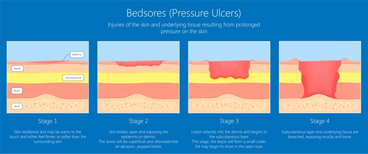 Comfort and Prevention in Ripple Mattress: Your Best Option for ...